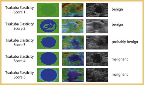 Inter And Intra Observer Agreement In Ultrasound Bi Rads
