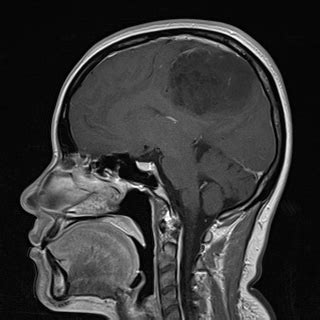 Diffuse Glioma Image Radiopaedia Org