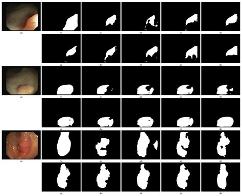 An Edge Enhanced Network For Polyp Segmentation