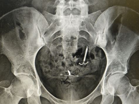 Removal Of Migrated Intrauterine Devices To Appendix Small Intestine And Omentum Case Reports