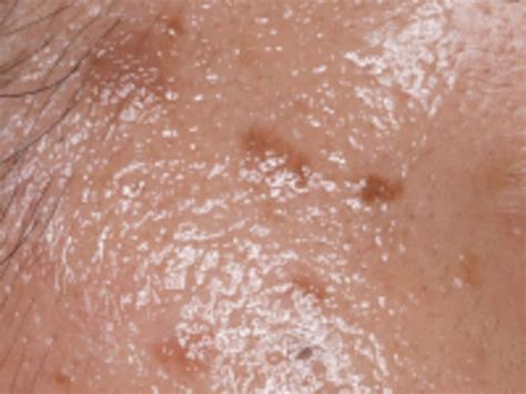 気になるシミの種類、原因、治療法を知る2 シミ All About