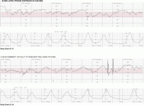 Fetal Heart Rate Monitoring Examples At Johnnie Hart Blog