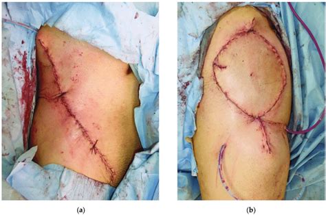 The Scip Flap Was Elevated Saving The Deep Fat A The Deep Fat