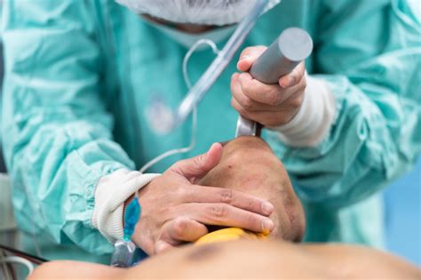Using Rapid Sequence Airway To Facilitate Preoxygenation And Gastric