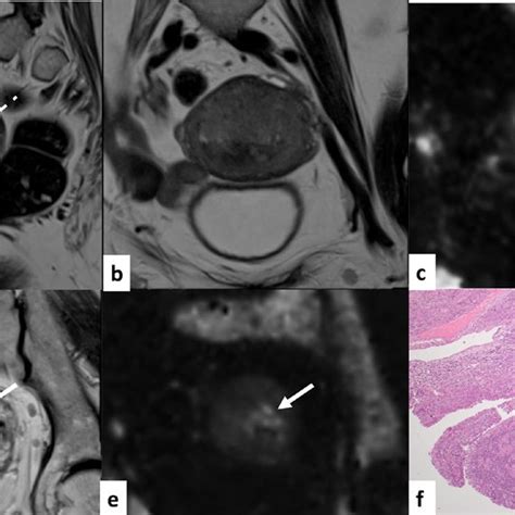 Ec Clear Cell Type Microscopic Disease A 62 Year Old Patient With