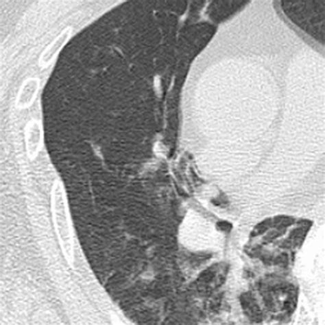 EEG Pattern Changes Of Patient A Convulsive Status Epilepticus