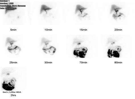 37 Year Old Female Patient With Present History Of Post Cholecystectomy Download Scientific