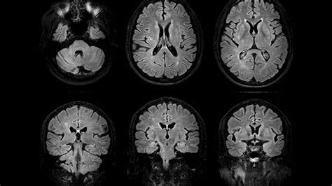 Acute Encephalopathy With Unusual Brain Lesions