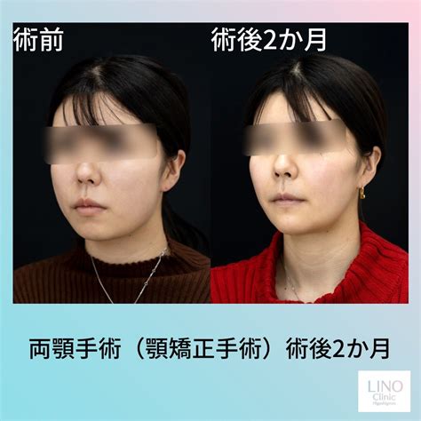 口元スッキリ両顎手術でゴボ口治療〜術後2か月〜【骨切り・顎矯正手術】 リノクリニック東銀座院長のブログ（美容外科・美容皮膚科・形成外科