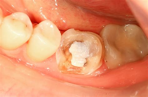 Dental Restorations Malathi Dental Clinic