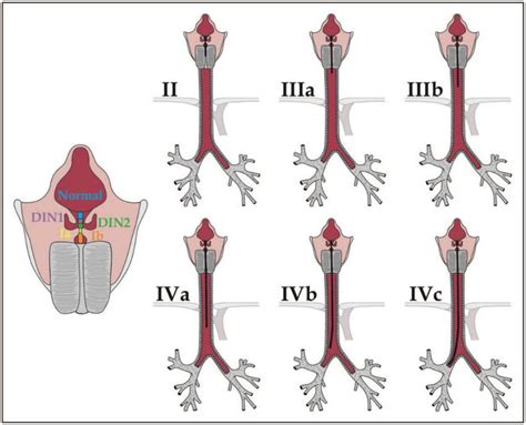 Proposed Modified Benjamin Inglis Classification Of Download
