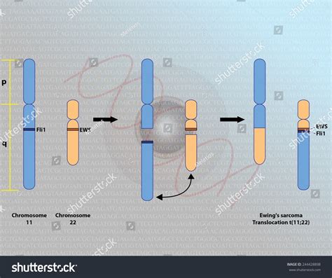 Ewings Sarcoma Chromosomal Translocation Stock Illustration 244428898 Shutterstock