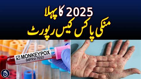 First Monkeypox Case Report Of 2025 Inkpk Aaj News Videos Aaj