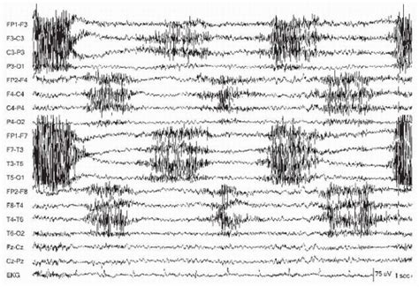 Artifacts Of Recording Neupsy Key