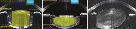 Lensar Femtosecond Laser
