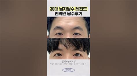 남자쌍수후기 레전드 [30대 절개 눈매교정] Shorts Youtube