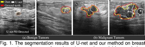 Figure From NU Net An Unpretentious Nested U Net For Breast Tumor Segmentation Semantic Scholar