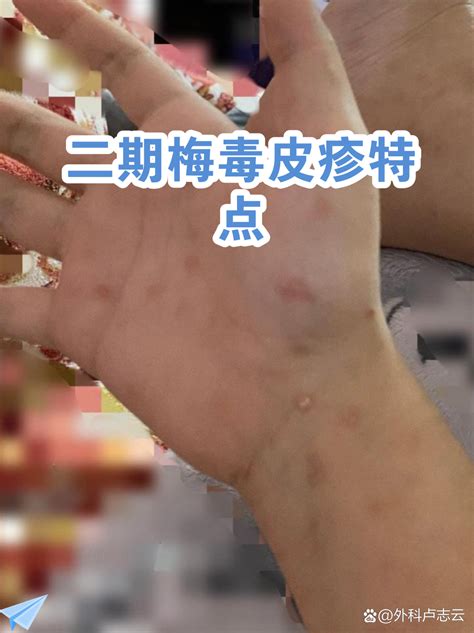 二期梅毒皮疹特点