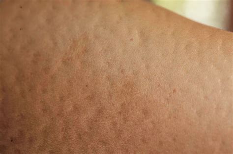 90 Lipodystrophy Pictures