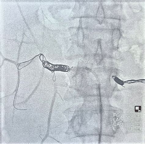 Radiographic Image Showing Bilateral Embolization Of Renal Arteries