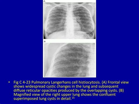 4 Diffuse Reticular Or Reticulonodular Pattern Pptx