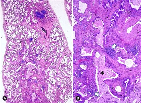Fibrotic Nonspecific Interstitial Pneumonia Pattern In A Patient With Download Scientific