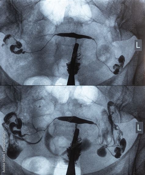 X Ray Image Of Hysterosalpingography Hsg Mri With Contrast Agent