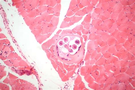 Trichinella Spiralis Larvae In Muscle Tissue Photomicrograph Showing