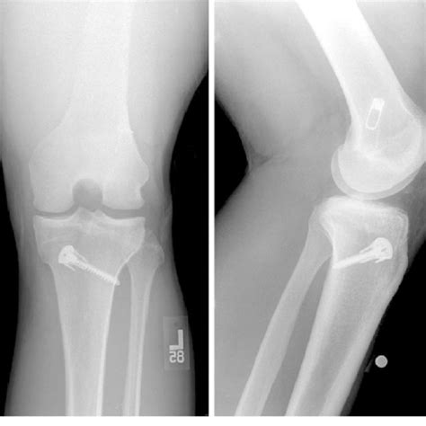 Sagittal Fat Suppressed Mri Of Failed Acl Reconstruction Acl Graft Is