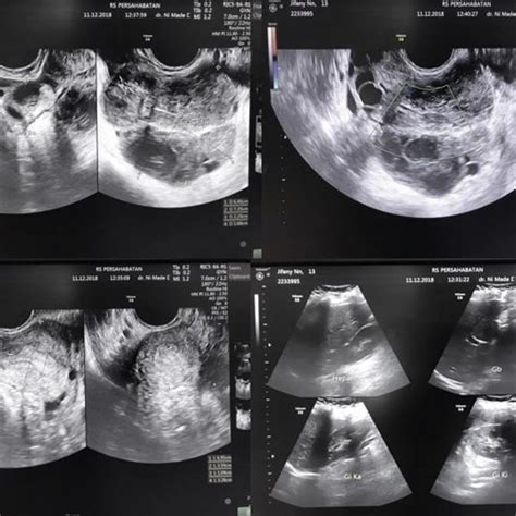 Ultrasound Findings Transrectal Download Scientific Diagram