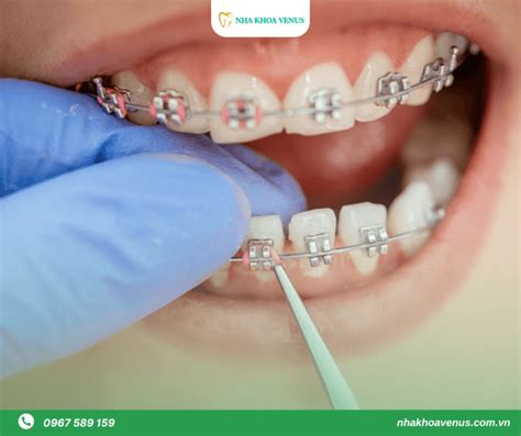 Giai Đoạn Đóng Khoảng Trong Niềng Răng Là Gì Thời Gian Bao Lâu