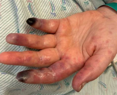 Acute Digital Necrosis From Granulomatosis With Polyangiitis A