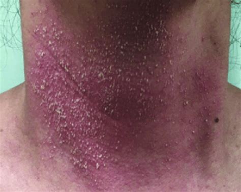 Acute Generalized Exanthematous Pustulosis Erythematous Eruption With