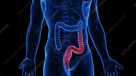 Ulcerative Colitis Illustration Stock Image F0384369 Science