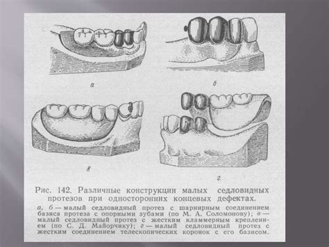 Изготовление микропротезов и седловидных протезов презентация онлайн