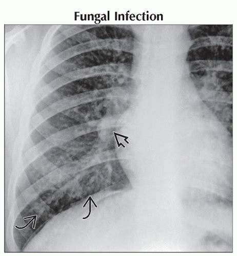 Multiple Pulmonary Nodules Obgyn Key