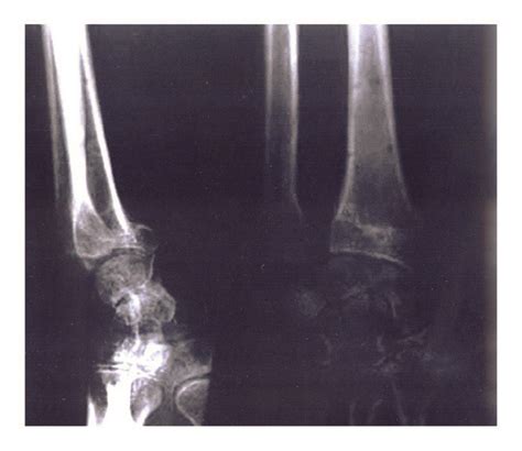 Preoperative A Postoperative B And Final Follow Up Radiographs Of
