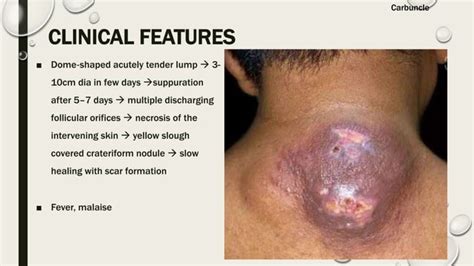 Bacterial120infections Pptx