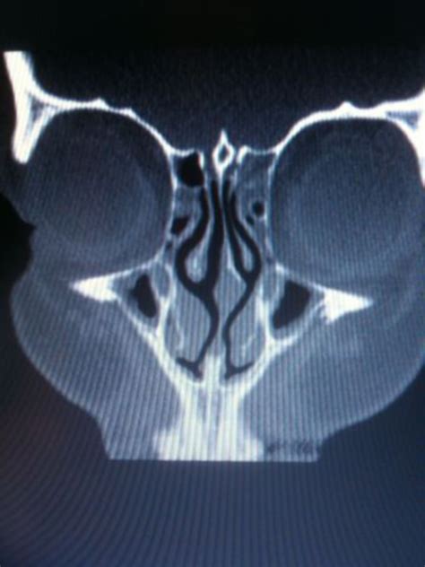 Chronic Pansinusitis 2 Doccheck