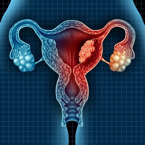 Waiting Time For Ovarian Cancer Treatment Found To Be Longer Than