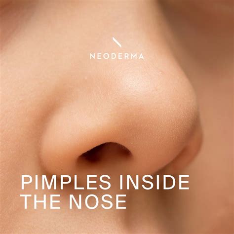 Pimples Inside The Nose Neoderma