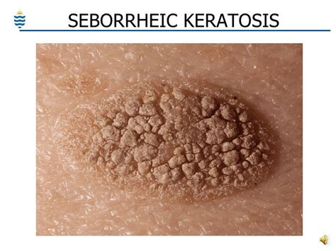 Seborrheic Keratosis Vs Melanoma Mole Or Melanoma Tell Tale Signs In