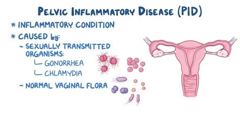 Pelvic Inflammatory Disease Clinical Sciences Osmosis Video Library