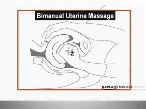Post Partum Hemorrhage Ppt
