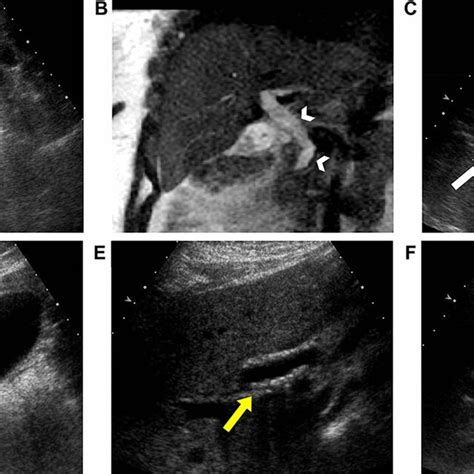 Biliary Colic And Choledocholithiasis In A 23 Year Old Pregnant Patient