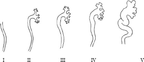 International Classification Of Vur Grade I Reflux Does Not Reach The