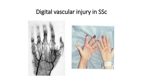Raynaud Phenomenon And Digital Ulcers In Scleroderma Ppt