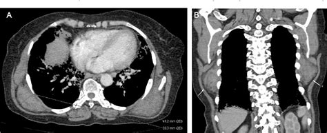 Figure 1 From Prevalence Of Elastofibroma Dorsi On Ct Is It Really An Uncommon Entity