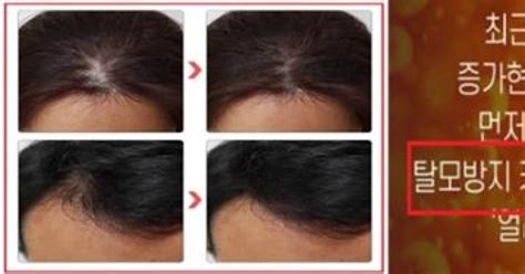 탈모인 울리는 허위·과대광고 식약처 탈모 예방 ·치료 샴푸 없다