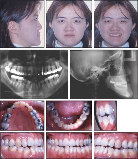 Maxillary Prognathism Correction